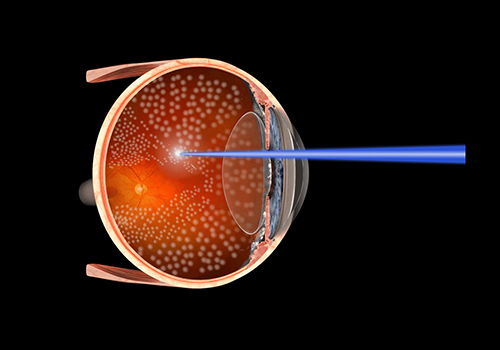 Láser YAG | Centro Oftalmológico Granollers